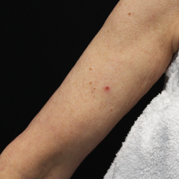 Before & After SkinTyte II™ | Bellingham, Burlington & Bothell ...