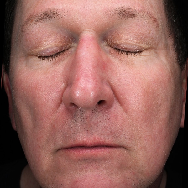 Before & After BBL® HERO™ | Bellingham, Burlington & Bothell ...