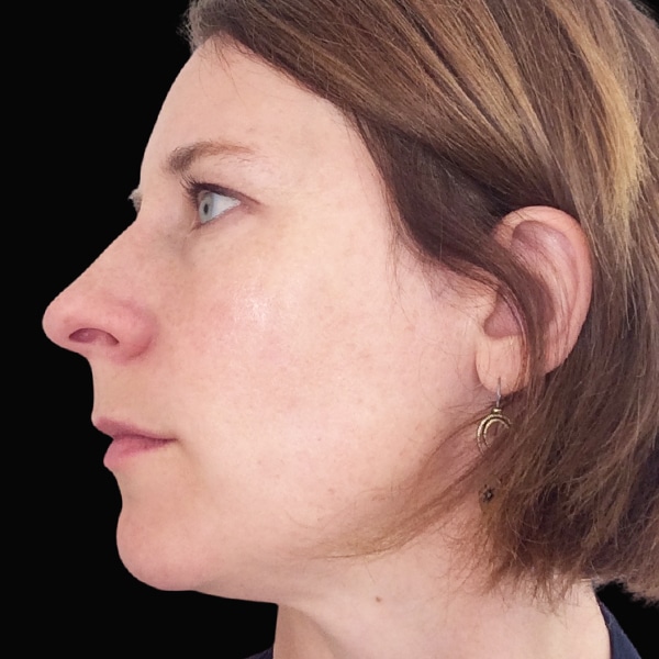 Before & After BBL® HERO™ | Bellingham, Burlington & Bothell ...