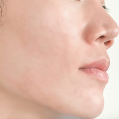 Acne - Med Spa | Bellingham | Burlington | Bothell | RejuvenationMD