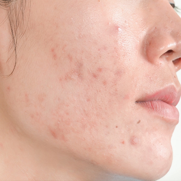 Acne - Med Spa | Bellingham | Burlington | Bothell | RejuvenationMD