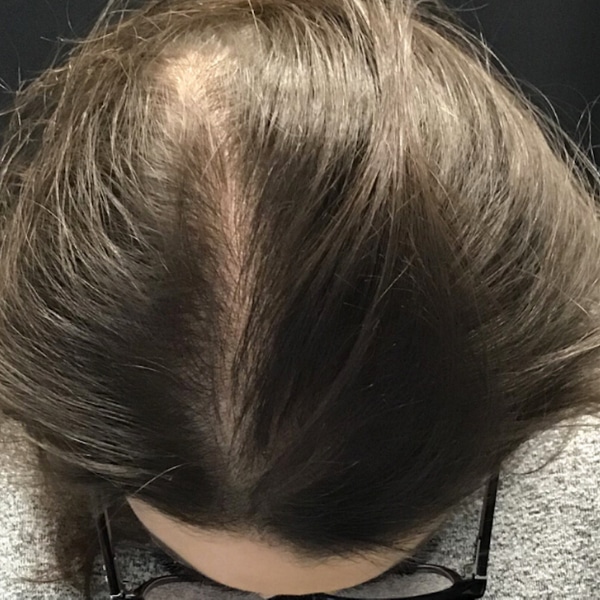 Hair Loss Treatment in Bellingham, Burlington & Bothell | RejuvenationMD