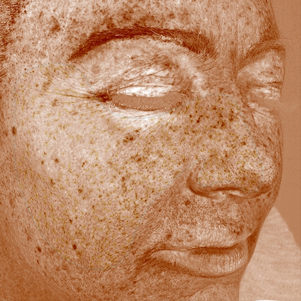 Sun Damage Treatment in Bellingham, Burlington & Bothell | RejuvenationMD