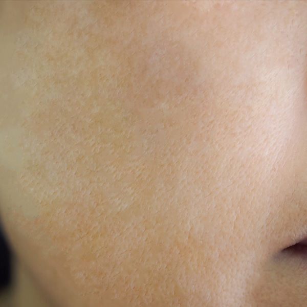 Hyperpigmentation Reduction in Bellingham, Burlington & Bothell ...