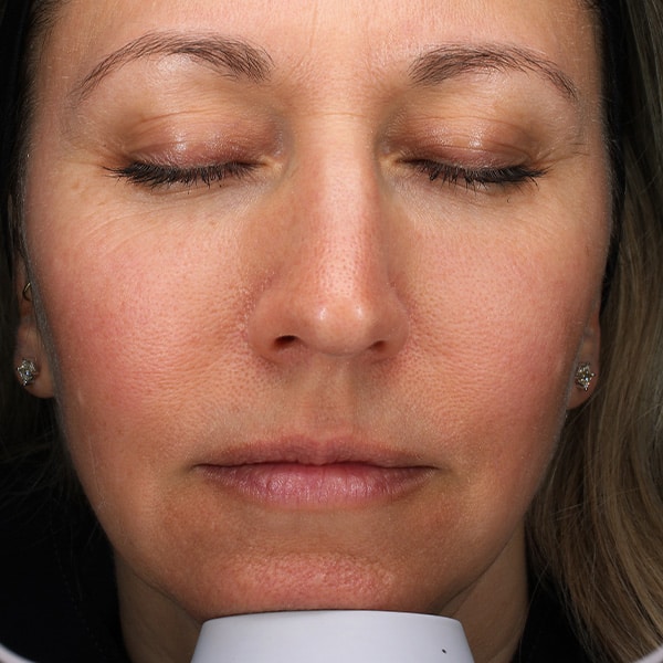 Before & After BBL® HERO™ | Bellingham, Burlington & Bothell ...