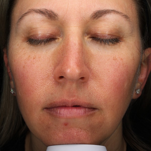 Before & After BBL® HERO™ | Bellingham, Burlington & Bothell ...