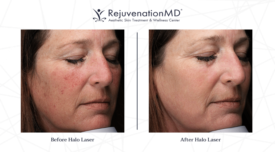 What to Expect from a Halo Laser Treatment | RejuvenationMD