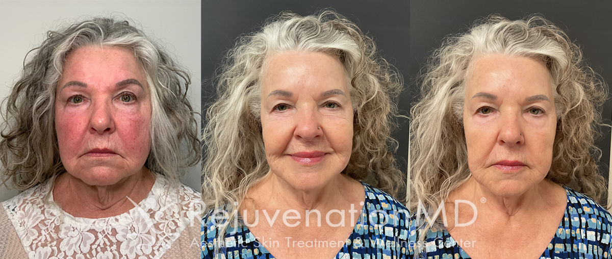 BBL® HERO™ Before and After: A Step-by-Step Look at Real Results ...