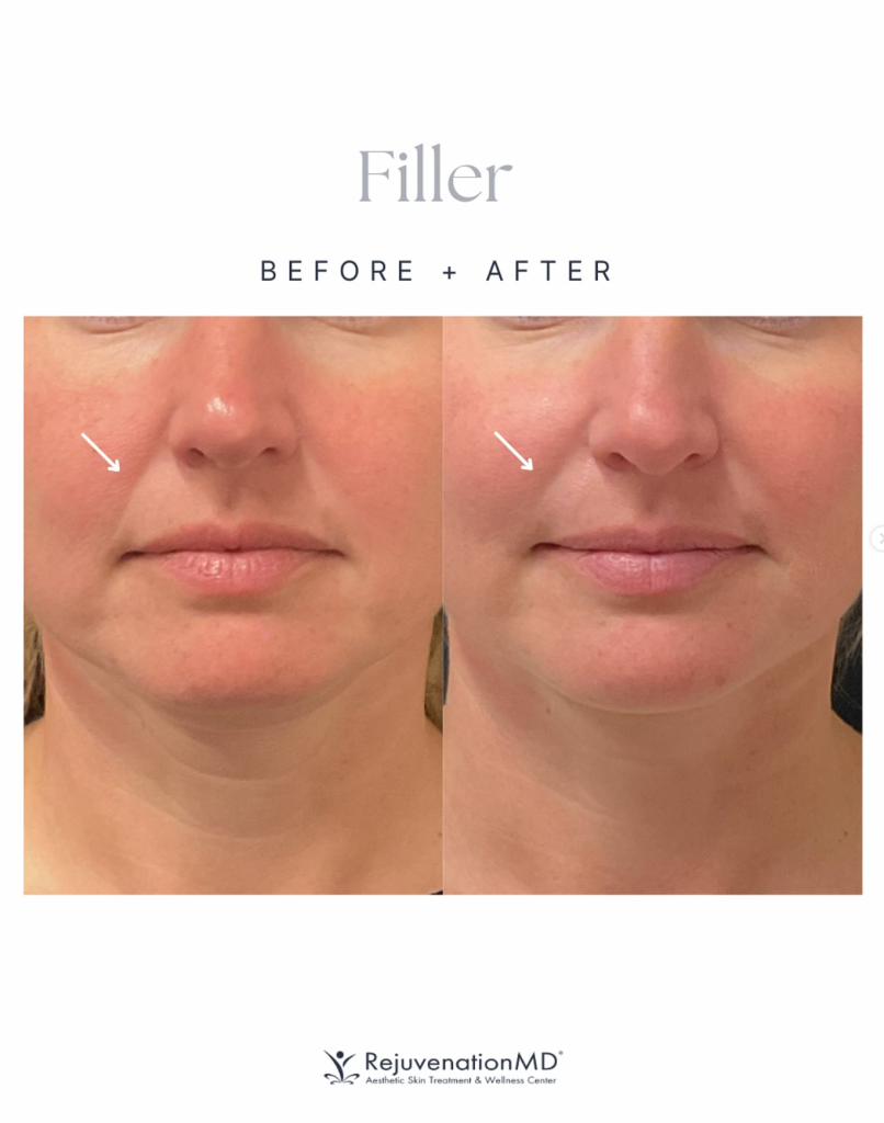 What Is Facial Balancing With Fillers? | RejuvenationMD
