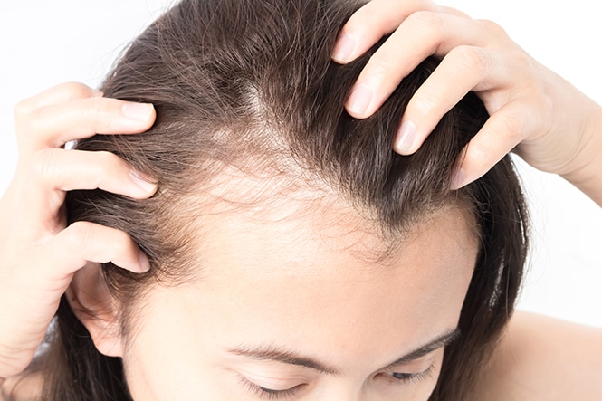 Hair loss treatment for women store