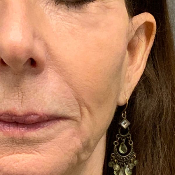 Dermal Fillers Gallery | RejuvenationMD | Med Spa | Bellingham ...