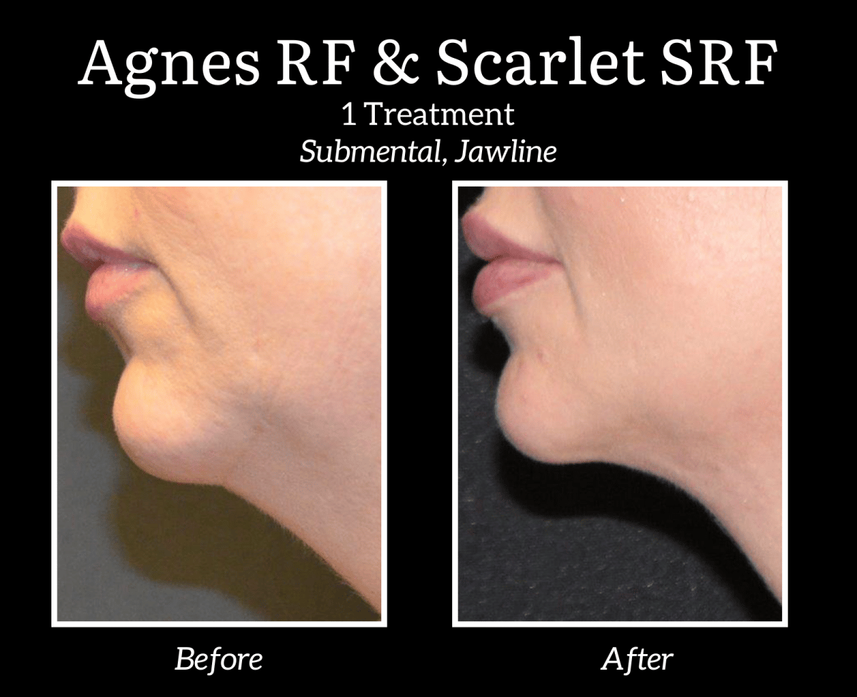 Agnes RF and Scarlet SRF | RejuvenationMD