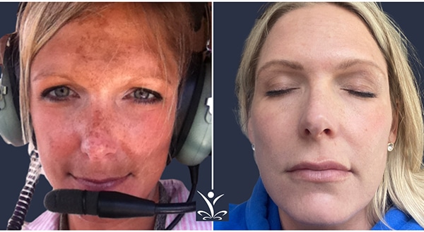 Our Patient’s Journey Correcting Hyperpigmentation | RejuvenationMD
