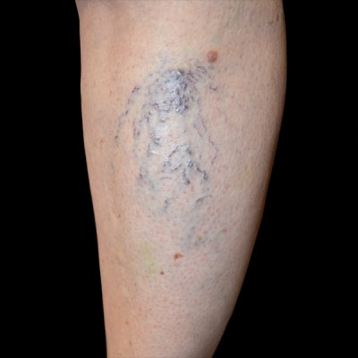 Prominent Blood Vessels in Bellingham, Burlington & Bothell ...