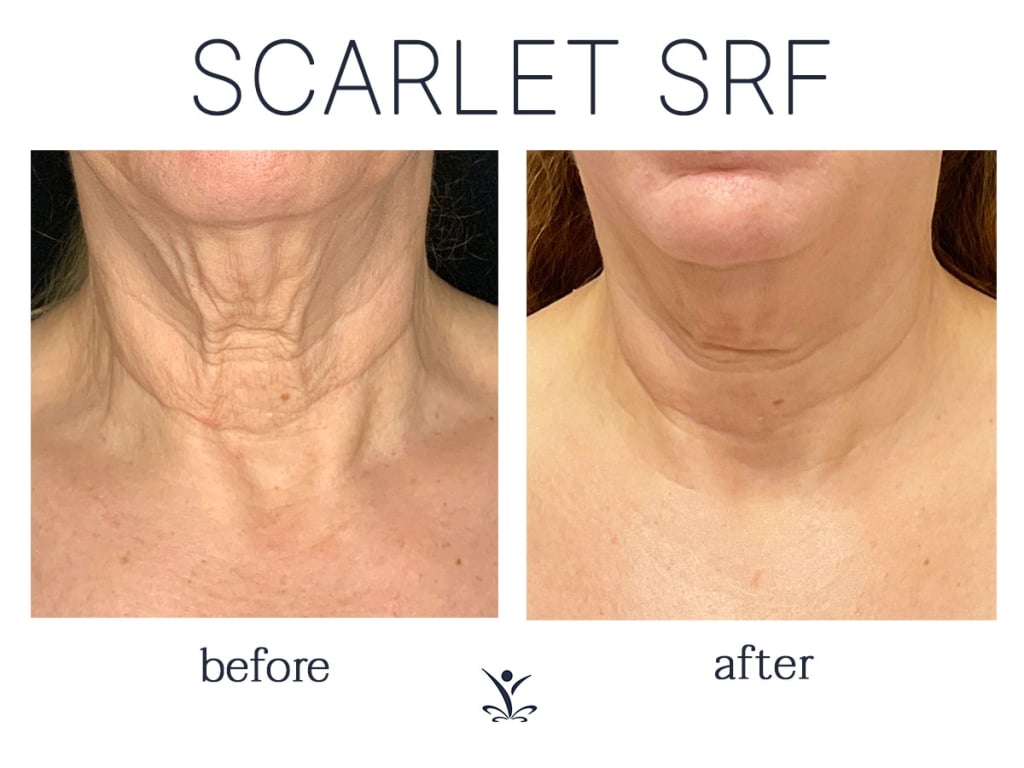 Rf Microneedling Neck Before And After Edu Svet Gob Gt