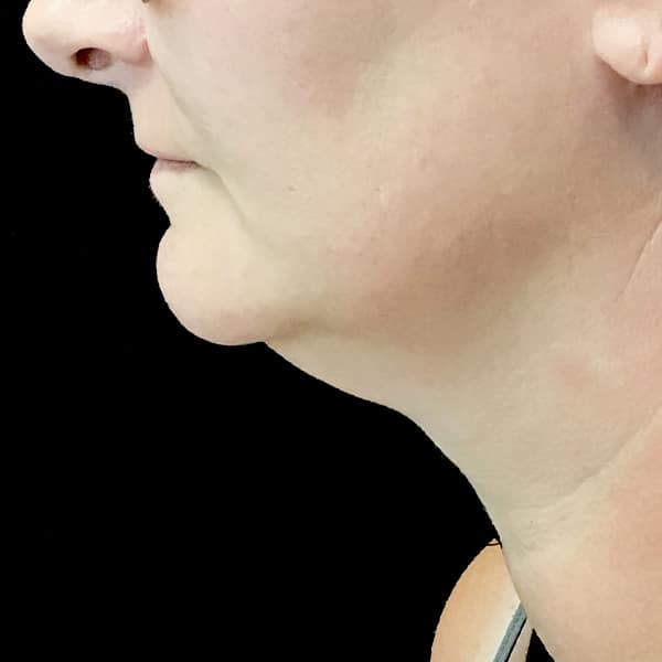 Double Chin Treatment in Bellingham, Burlington & Bothell | RejuvenationMD