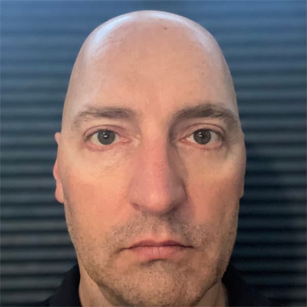 Vampire Facelift® Gallery Gallery | RejuvenationMD | Med Spa ...