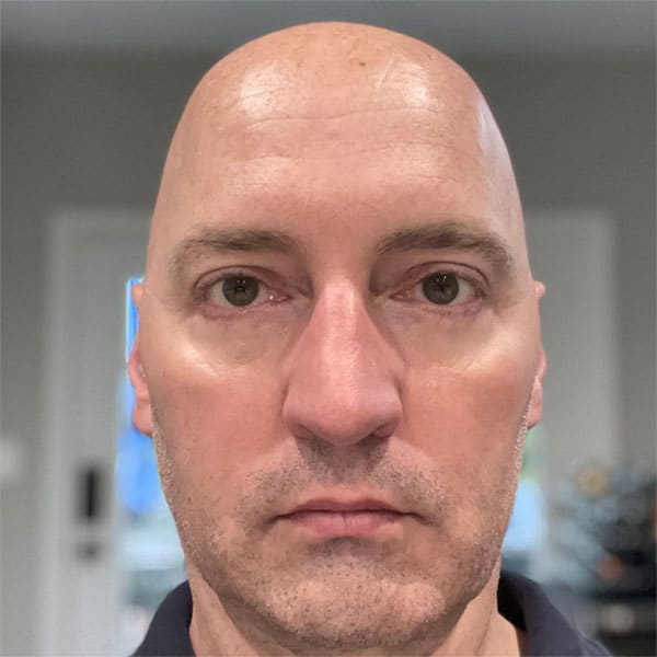 Vampire Facelift® Gallery Gallery | RejuvenationMD | Med Spa ...