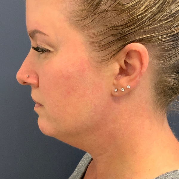 PDO Threads Gallery | RejuvenationMD | Med Spa | Bellingham ...