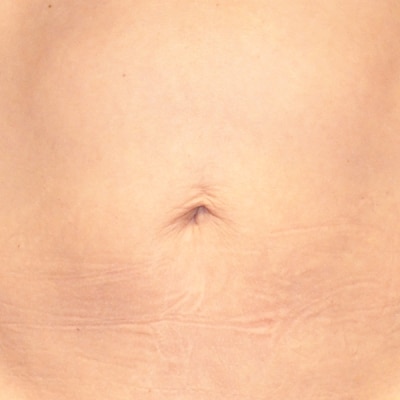 SkinTyte II™ in Bellingham, Burlington & Bothell | RejuvenationMD